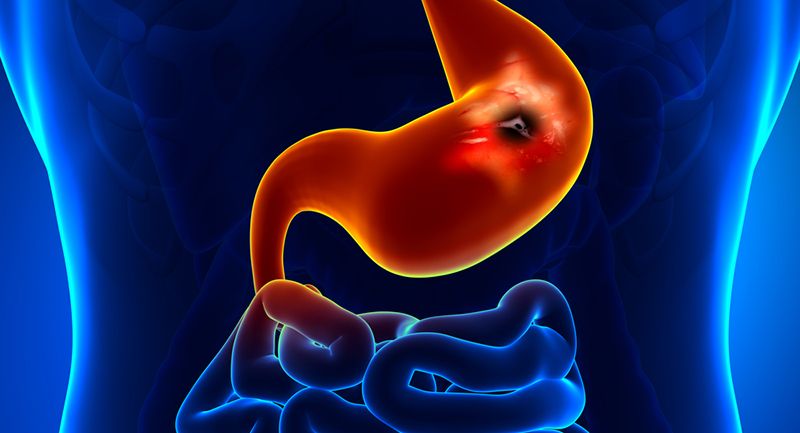 Gastrik Ülser Belirtileri, Nedenleri ve Tedavi Yöntemleri